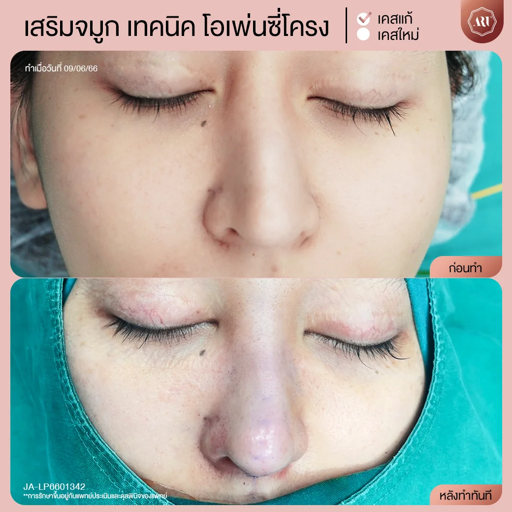 เสริมจมูกแบบไหนสวย? รีวิวเสริมจมูกจากดาราอินฟลูเอ็นเซอร์ Arty Nose