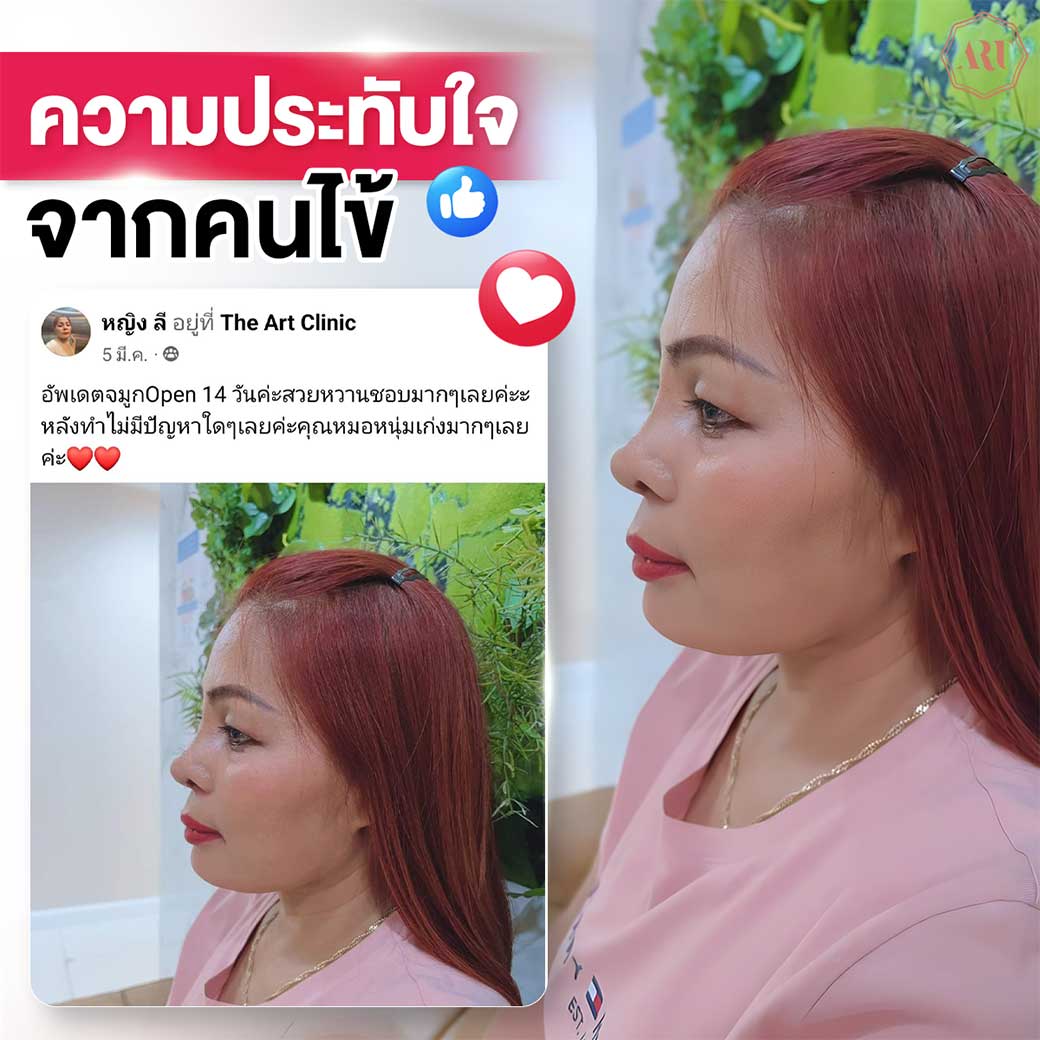 เสริมจมูกแบบไหนสวย? รีวิวเสริมจมูกจากดาราอินฟลูเอ็นเซอร์ Arty Nose